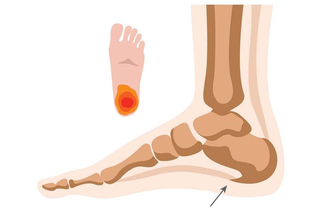 Hälsporre: Lindra och förebygg smärtan - Hemmets Journal