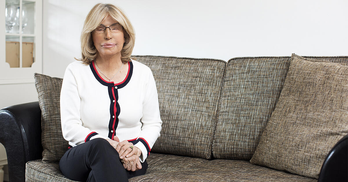 Maria Rashidi: “Mitt ansikte brann upp och rann av mig” - Icakuriren